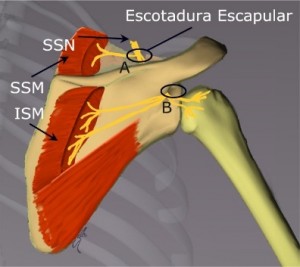 Neuropatía compresiva del nervio supraescapular en jugadores de tenis y ...